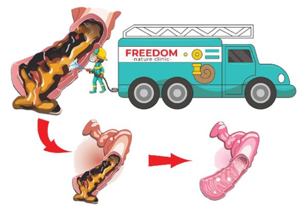 Colon Hydro Therapy – Freedom Nature Clinic